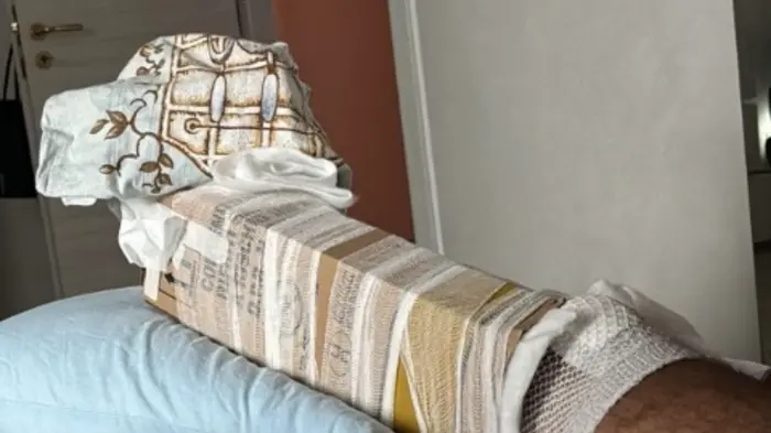 In the hospital the splints are missing, the fracture is blocked with ...